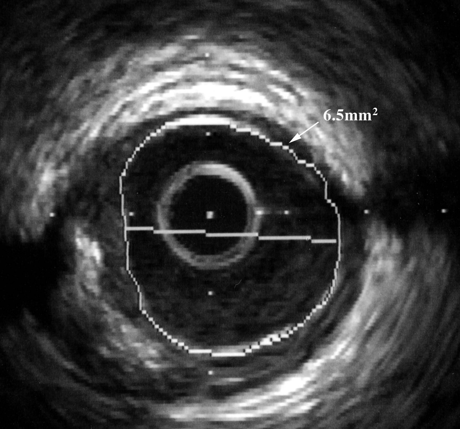 The Angiographic Step-Up and Step-Down: A Surrogate for Optimal Stent ...