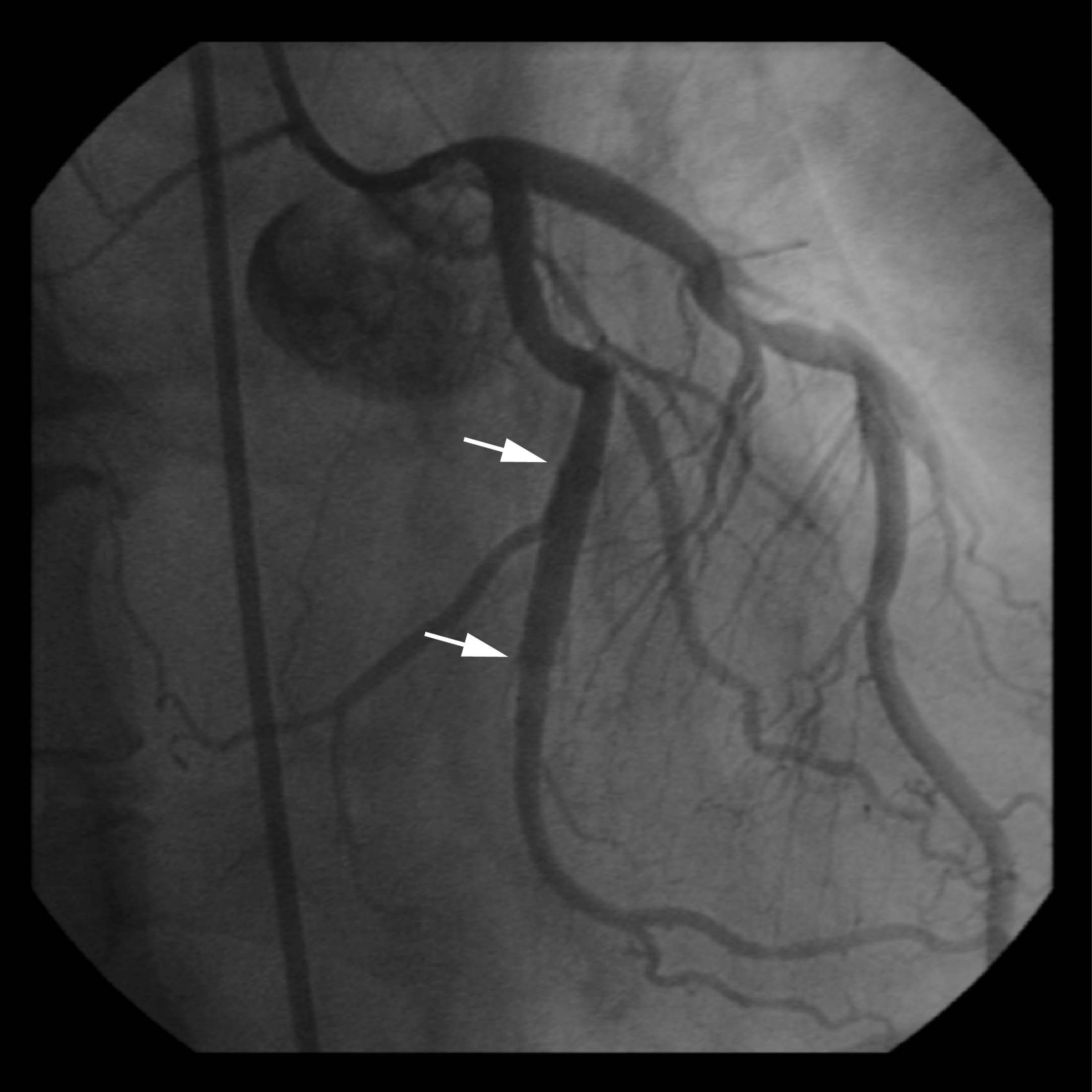 The Angiographic Step-Up and Step-Down: A Surrogate for Optimal Stent ...