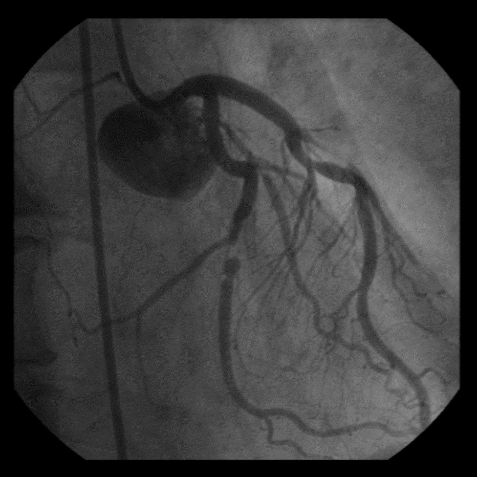 The Angiographic Step-Up and Step-Down: A Surrogate for Optimal Stent ...