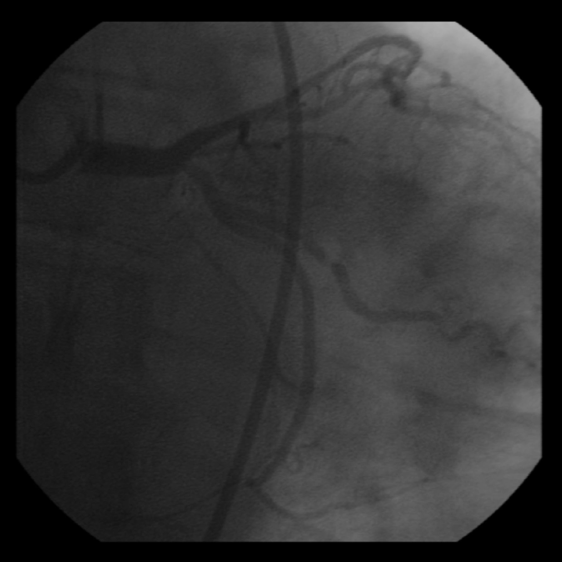 The Angiographic Step-Up and Step-Down: A Surrogate for Optimal Stent ...