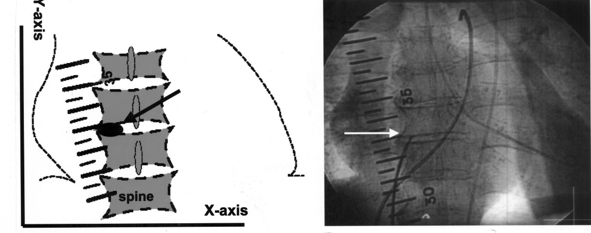 The Guidewire Technique for Transseptal Puncture