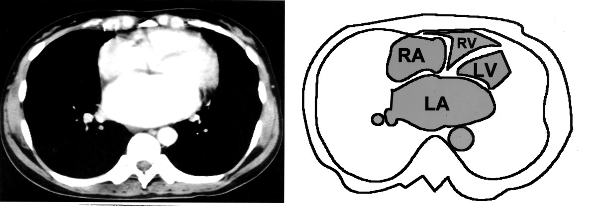 The Guidewire Technique for Transseptal Puncture