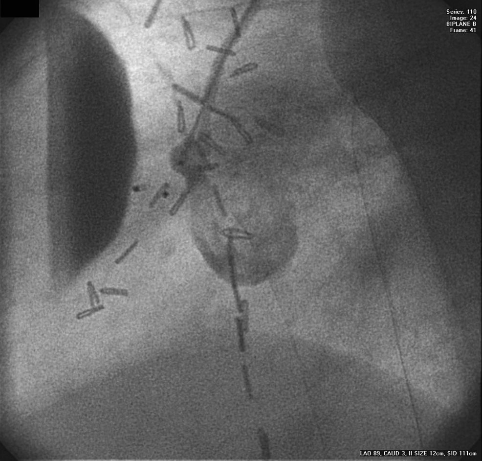 Ruptured Giant Right Coronary Artery Aneurysm Percutaneously Plugged