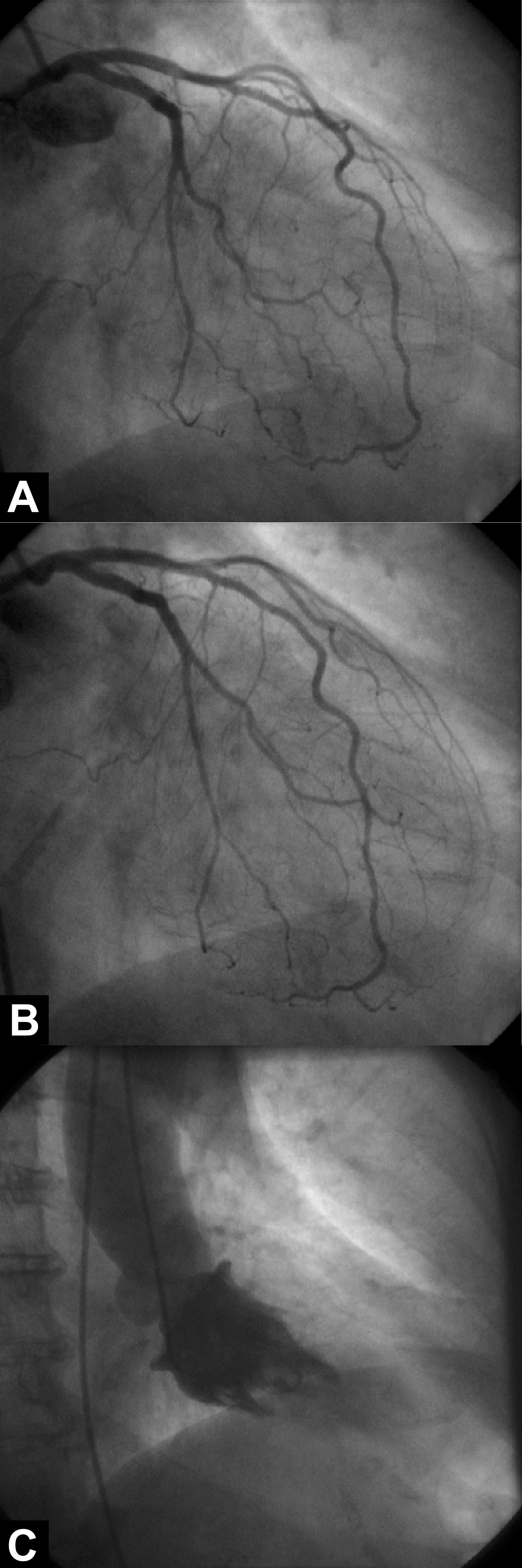 Resolution of Myocardial Bridge-Related Wall Motion Abnormality and ...