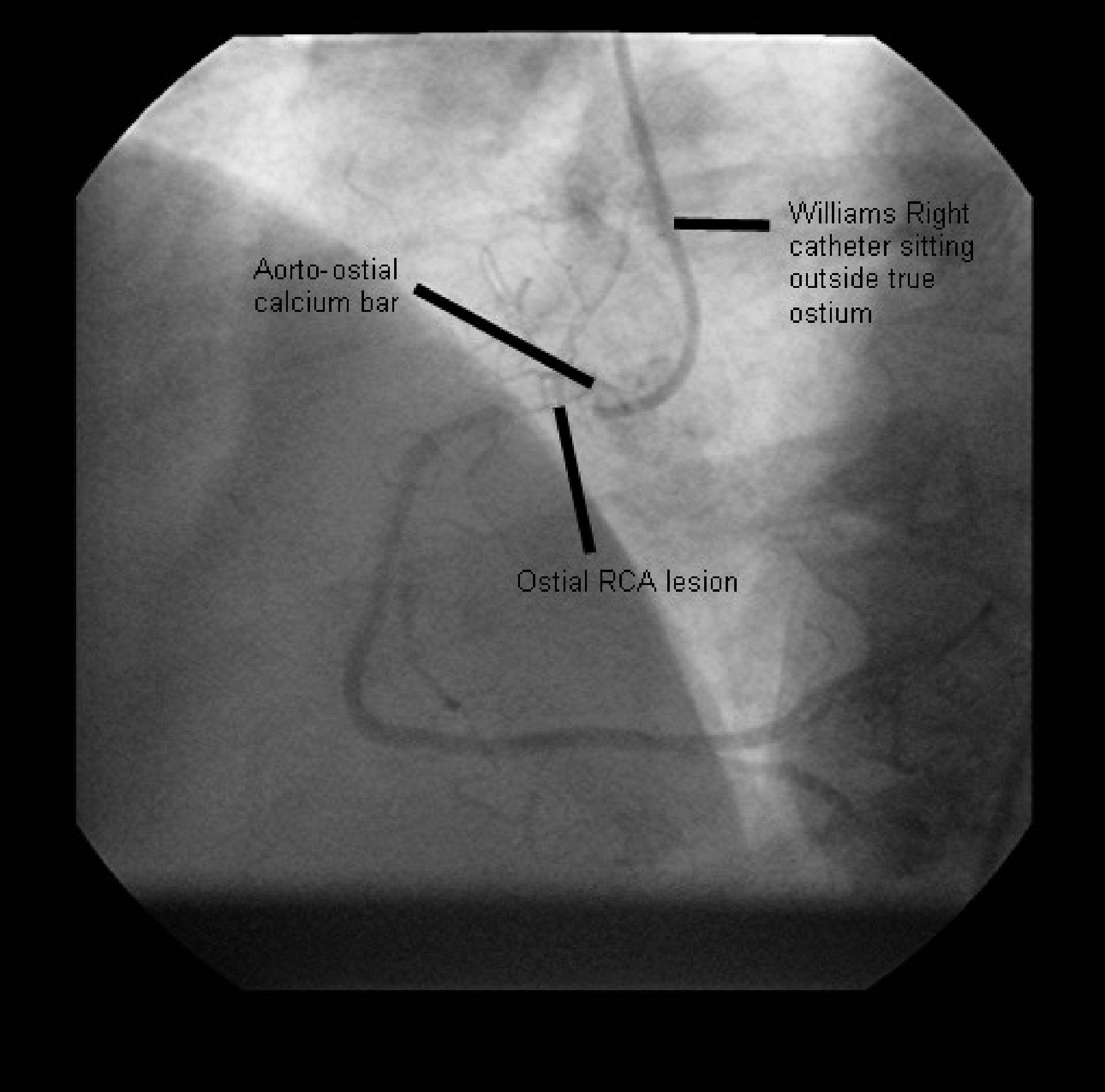 Ostial RCA Intervention: Guiding Catheter Challenges and Use of a Buddy ...