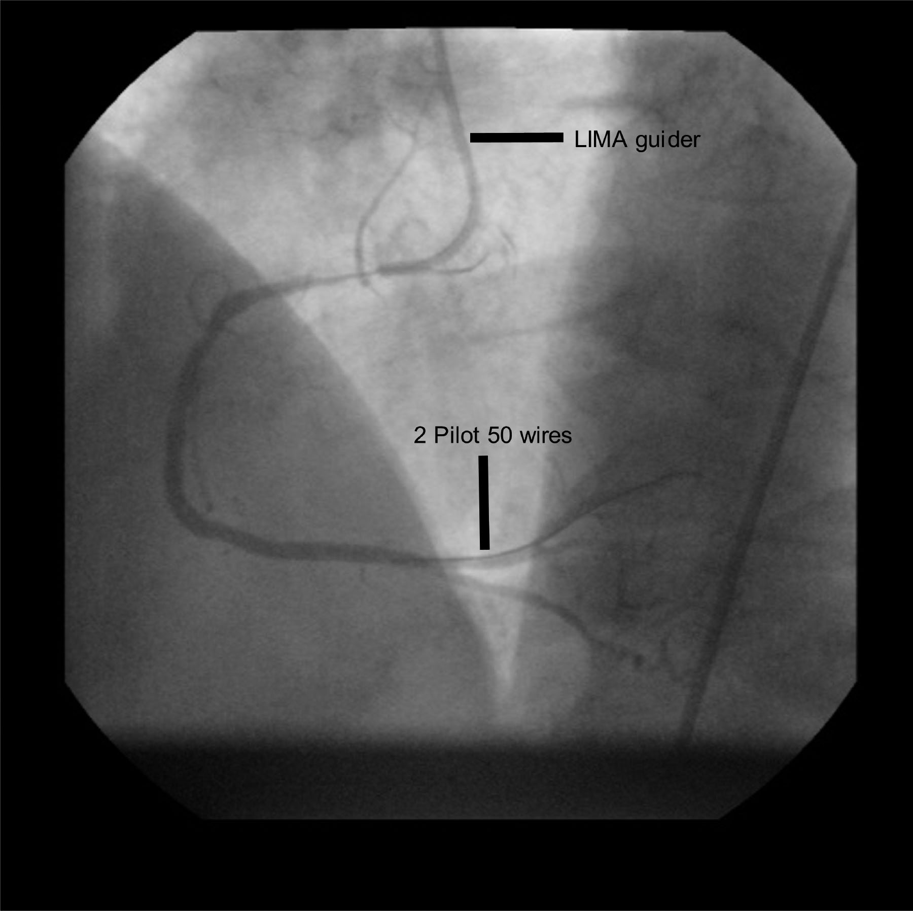Ostial RCA Intervention: Guiding Catheter Challenges and Use of a Buddy ...