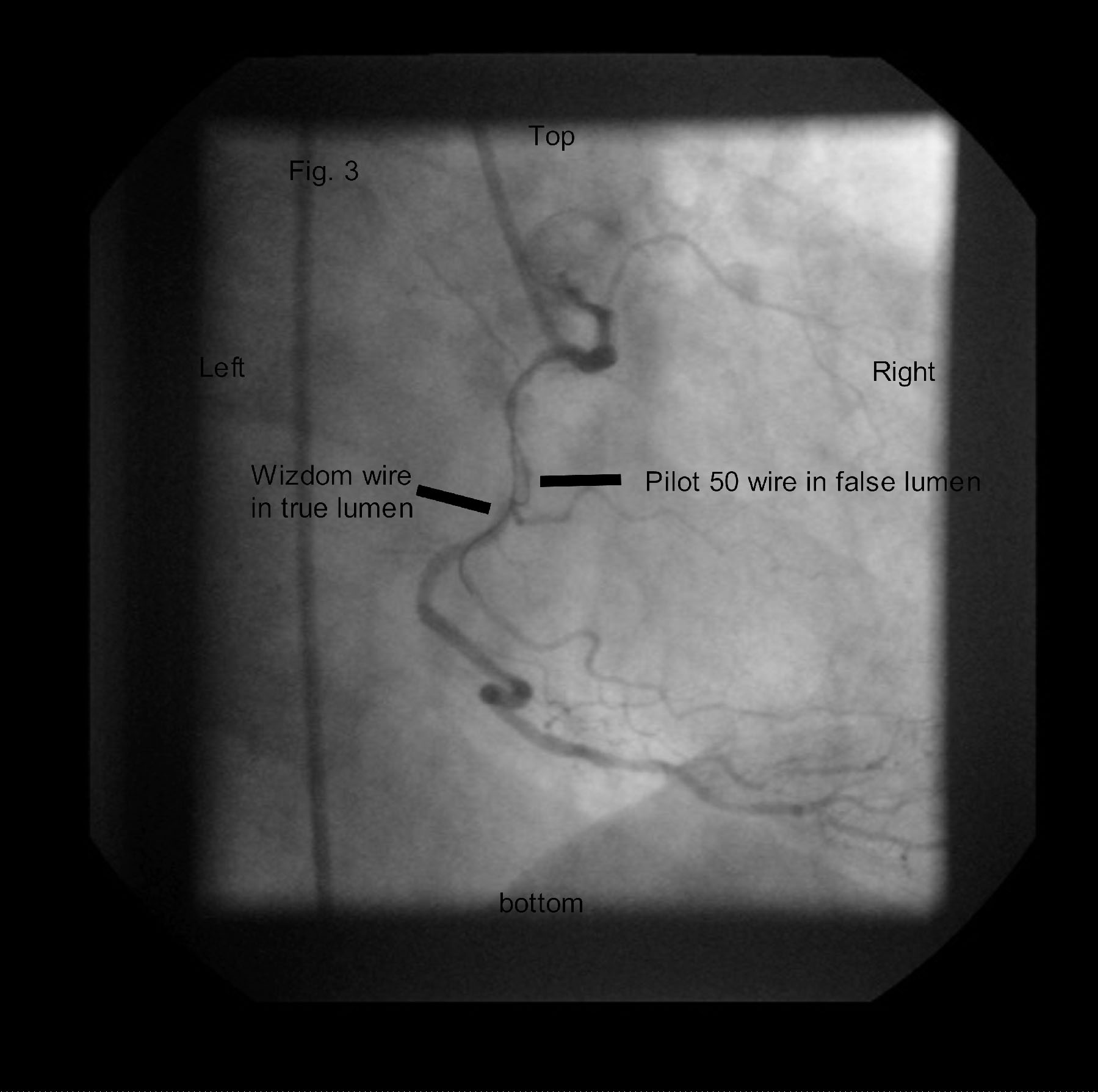 The Parallel Wire Technique to Deal with Wire-Induced Dissection of a ...