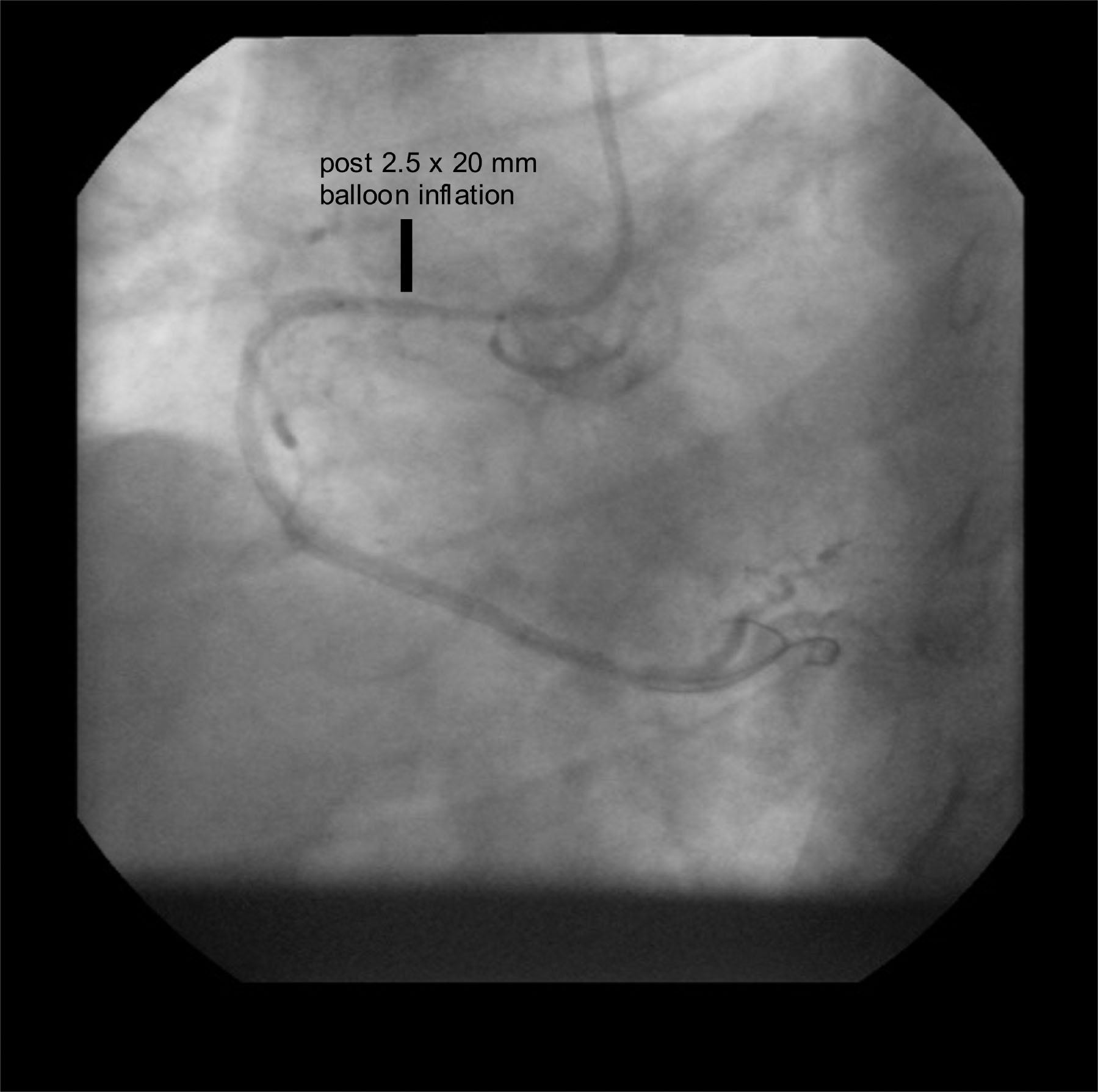 Ostial RCA Intervention: Guiding Catheter Challenges and Use of a Buddy ...
