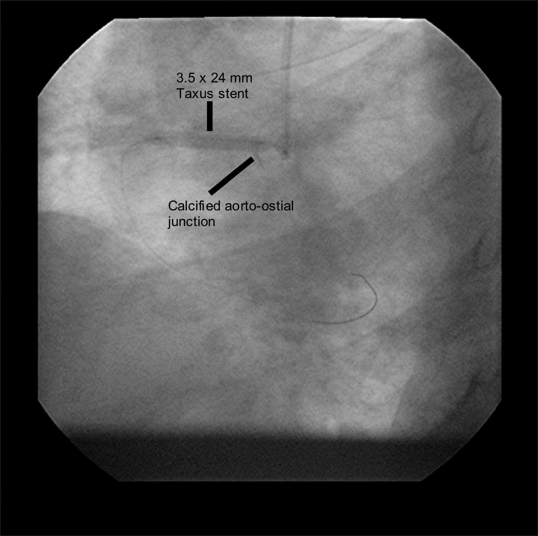 Ostial RCA Intervention: Guiding Catheter Challenges and Use of a Buddy ...