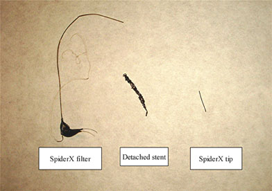 Retrieval of a Detached Partially Expanded Stent Using the SpideRX and ...