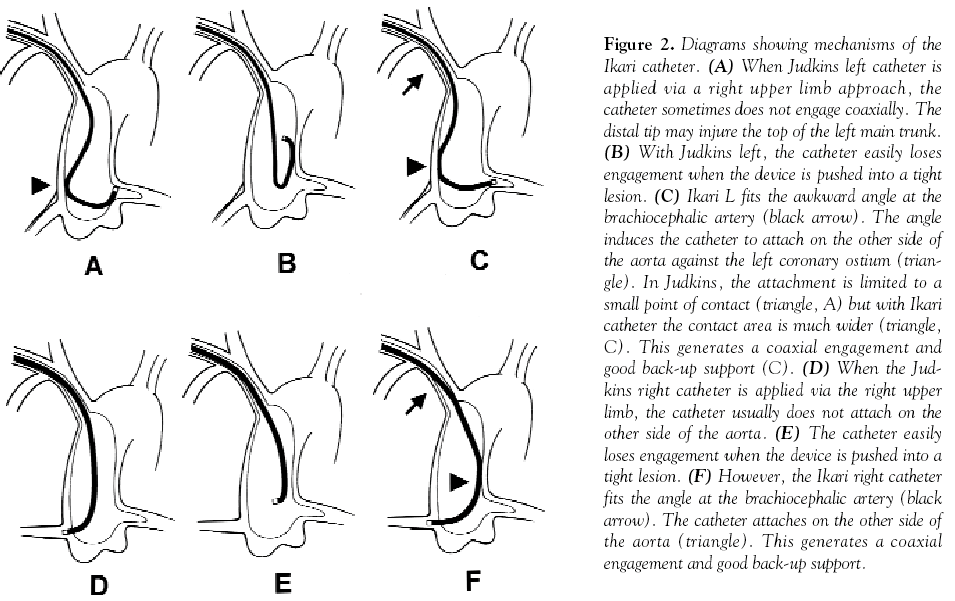Initial Characterization of Ikari Guide Catheter for Transradial ...