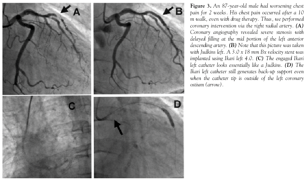 Initial Characterization of Ikari Guide Catheter for Transradial ...