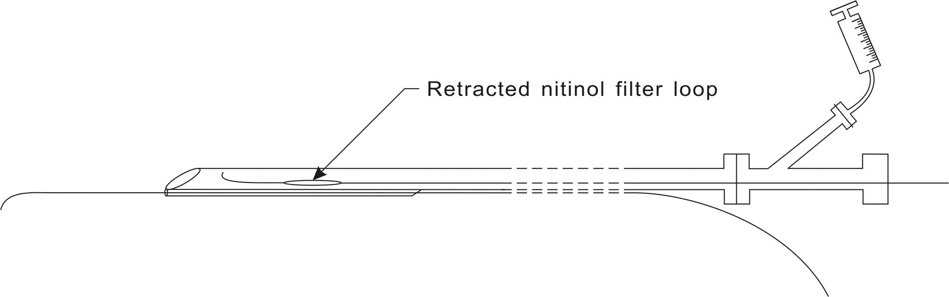 Export Aspiration Catheter-Enhanced FilterWire‚Ñ¢ Delivery: An ...