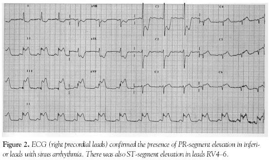 PR-Segment Elevation in Inferior Leads: An Atypical ...