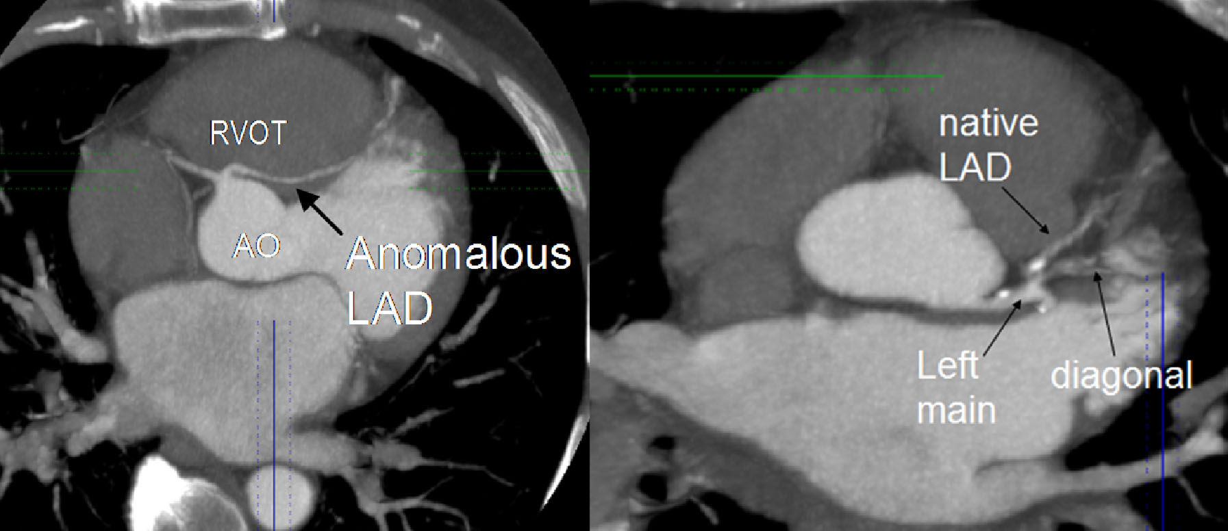 A Rare Case of Anomalous Left Anterior Descending Artery with a Large ...