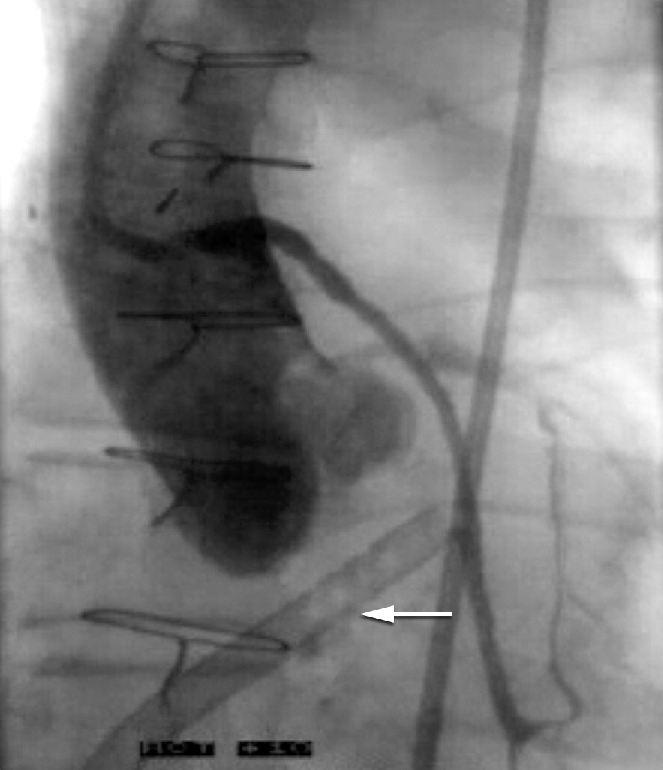 Use of the TandemHeart Percutaneous Ventricular Assist Device to ...