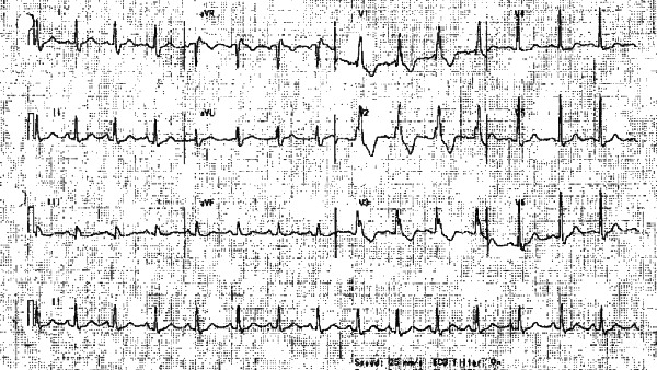 Complete Heart Block Due to Lyme Carditis