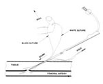 Novel Femoral Artery Puncture Closure Device in Patients Undergoing ...