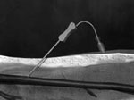 Novel Femoral Artery Puncture Closure Device in Patients Undergoing ...
