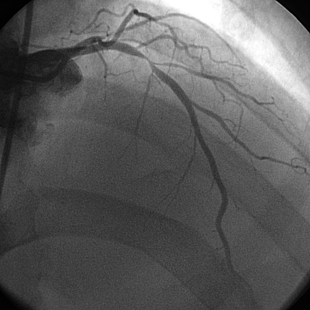 A New Proposed Simplified Classification of Coronary Artery Bifurcation ...
