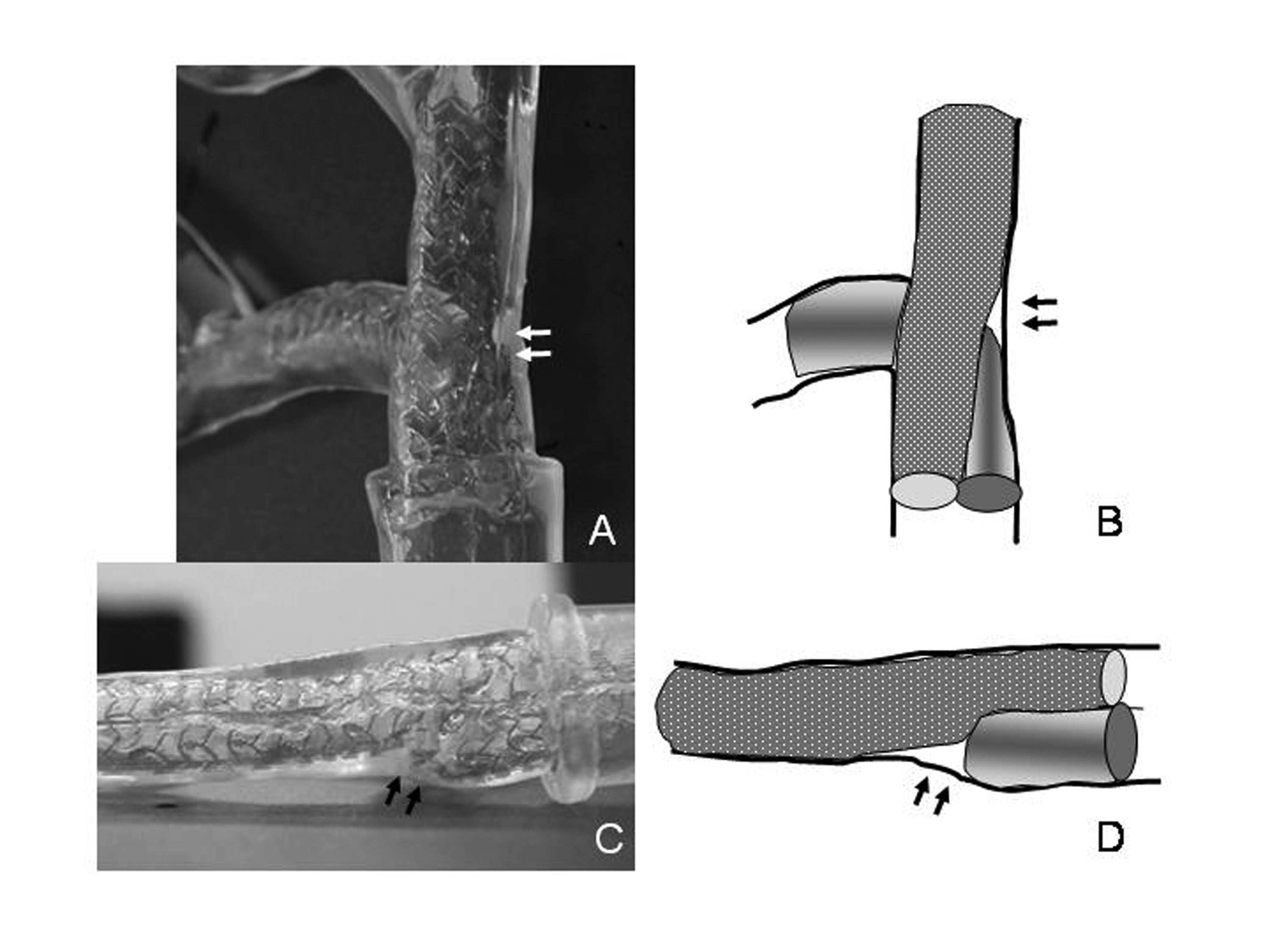 Incomplete Stent Apposition In A Left Main Bifurcated Lesion After incomplete-stent-apposition-in-a-left-main-bifurcated-lesion-after