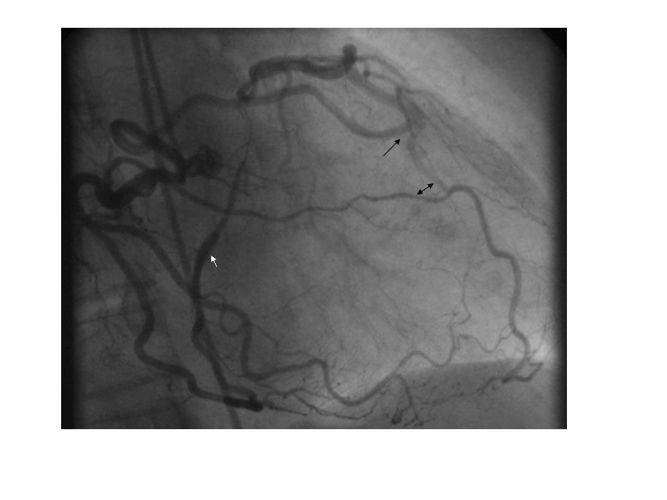 Single Coronary Artery from Right Aortic Sinus with Septal Course of ...