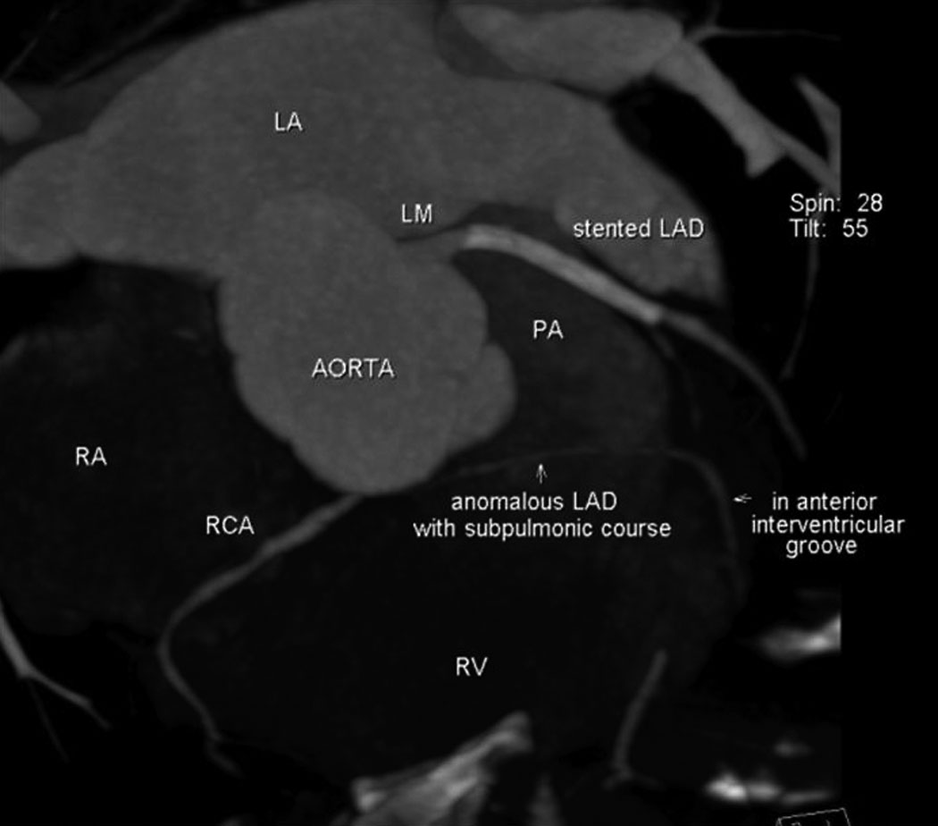 A Rare Type of Dual Left Anterior Descending Artery Distribution ...