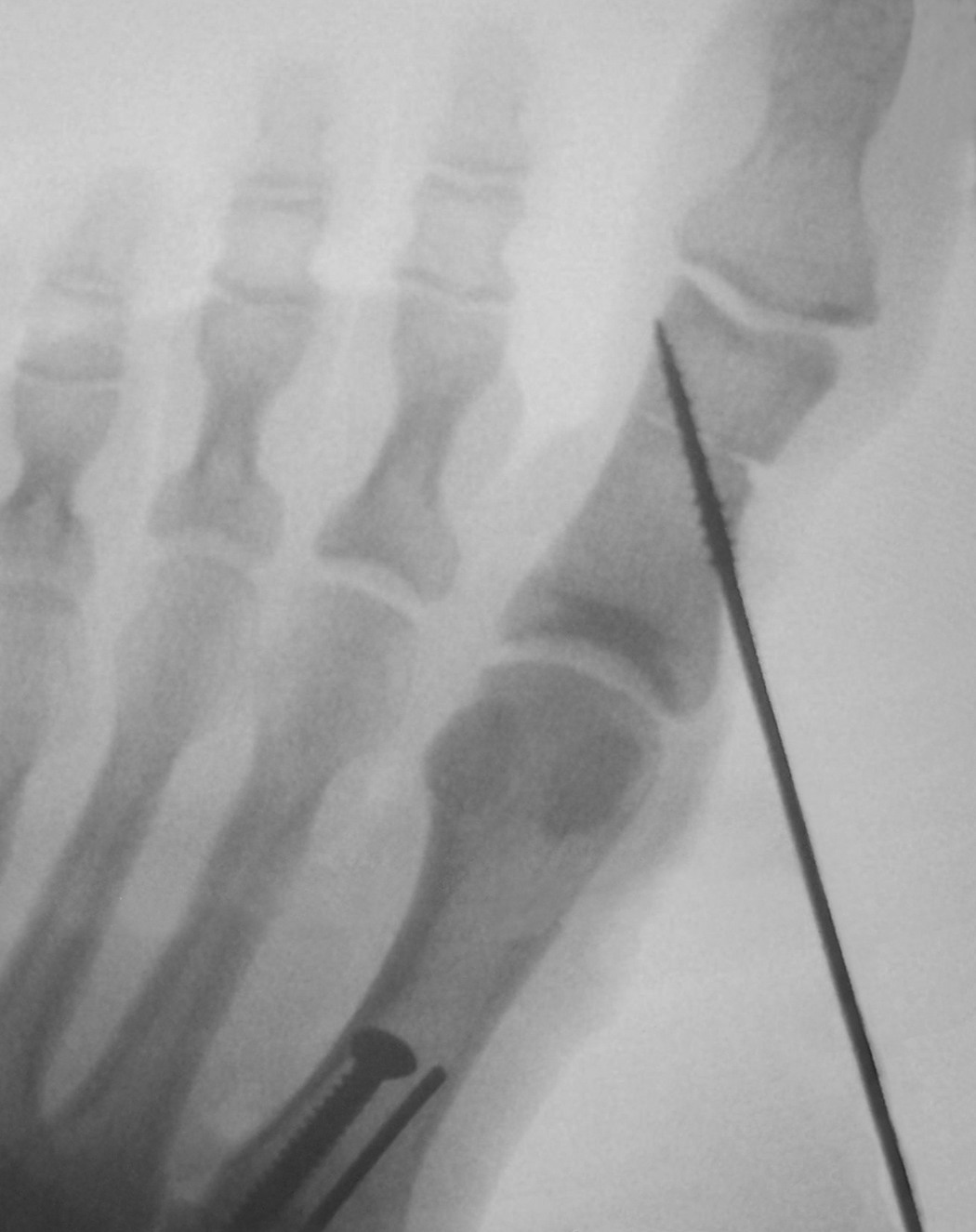 Key Pearls For An Alternative Approach To The Akin Osteotomy