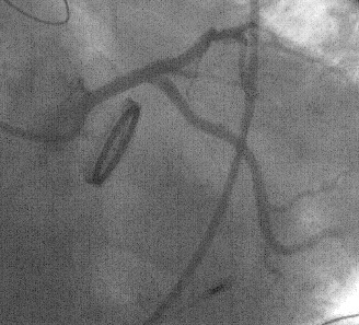 Successful Treatment in a Case of Acute Aortic Dissection Complicated ...