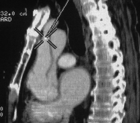 Successful Treatment in a Case of Acute Aortic Dissection Complicated ...