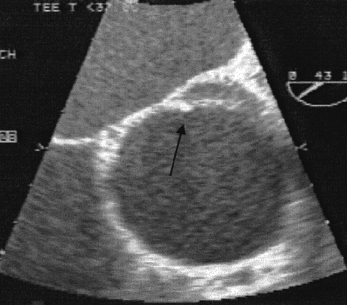 Successful Treatment in a Case of Acute Aortic Dissection Complicated ...