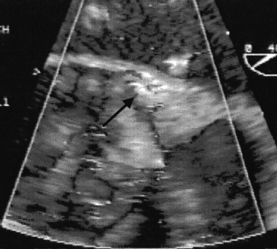 Successful Treatment in a Case of Acute Aortic Dissection Complicated ...