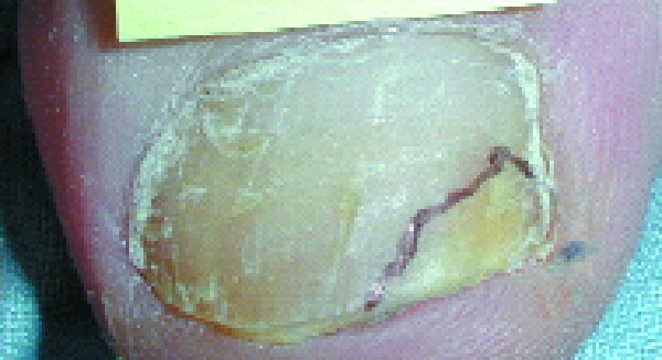 A Guide To Treatments For Onychomycosis