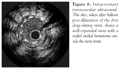Intravascular Ultrasound Imaging in the Diagnosis and Treatment of ...