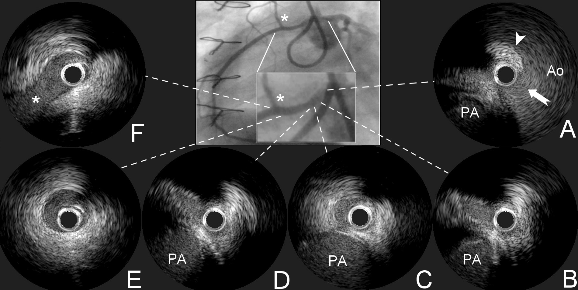 Intravascular Ultrasound to Guide Stenting of an Anomalous Right ...
