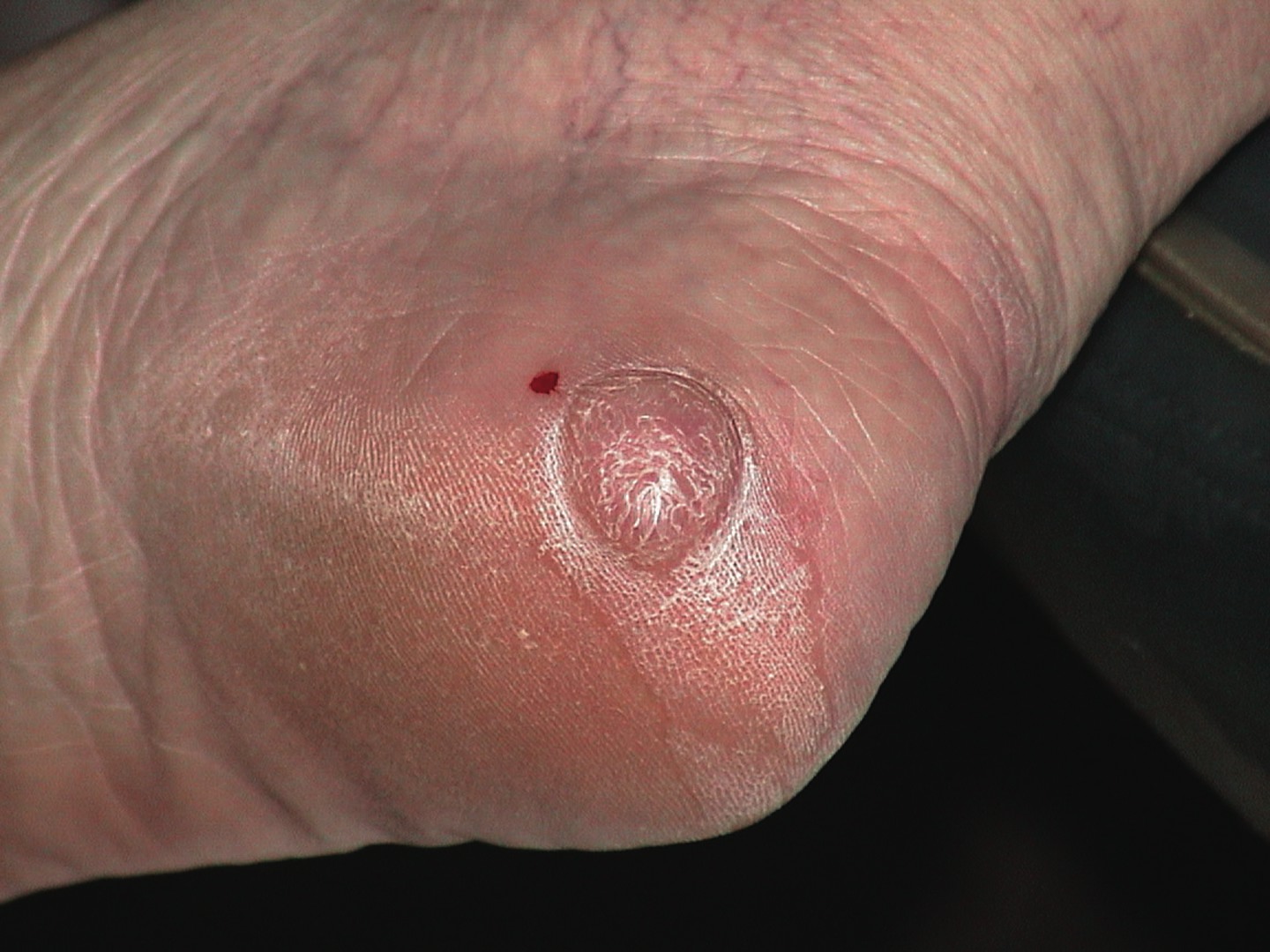 Soft Tissue Masses: When To Treat, When To Refer