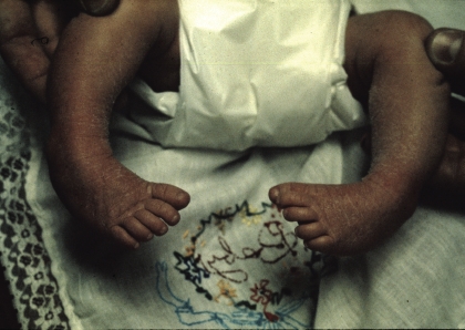 Congenital Foot Deformities: A Guide To Conservative Care