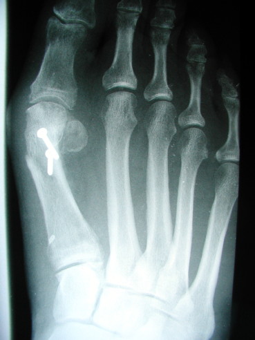 Sesamoid Bone Removal