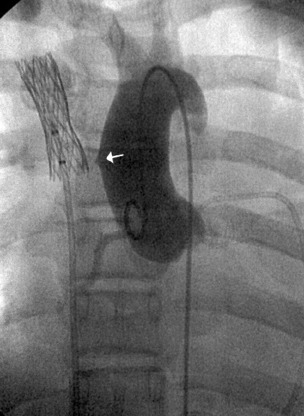 Late Superior Vena Cava Perforation and Aortic Laceration After Stent ...