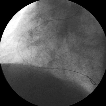 The Buddy Wire Technique Is Useful in Transradial Coronary Stenting of ...