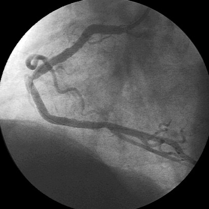 The Buddy Wire Technique Is Useful in Transradial Coronary Stenting of ...