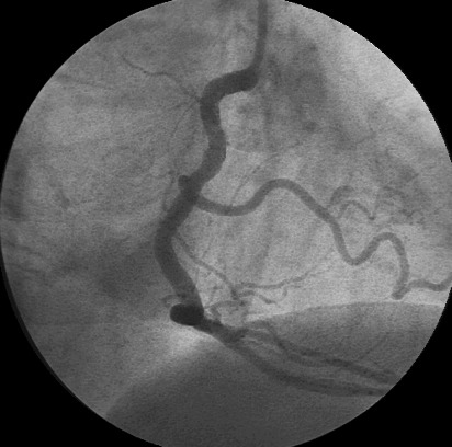 The Buddy Wire Technique Is Useful in Transradial Coronary Stenting of ...