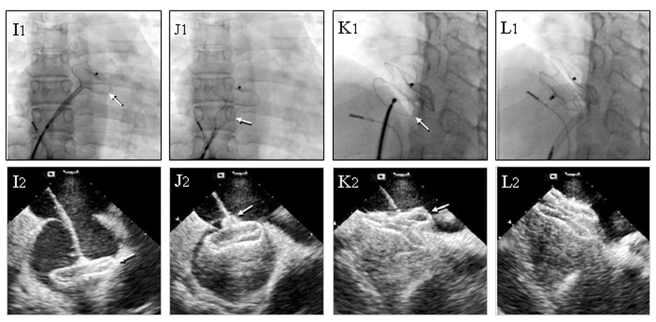 Intracardiac Echocardiography in Cardiovascular Catheter-Based ...