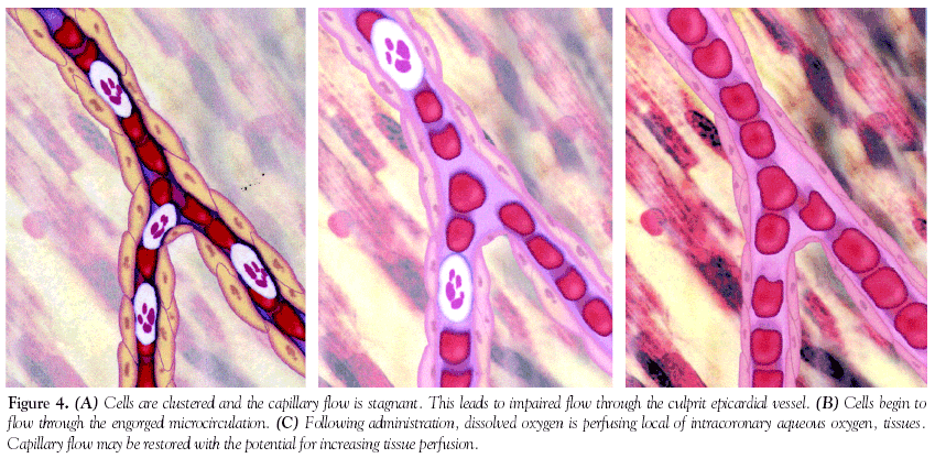 Potential for Myocardial Salvage Utilizing Direct Intracoronary ...