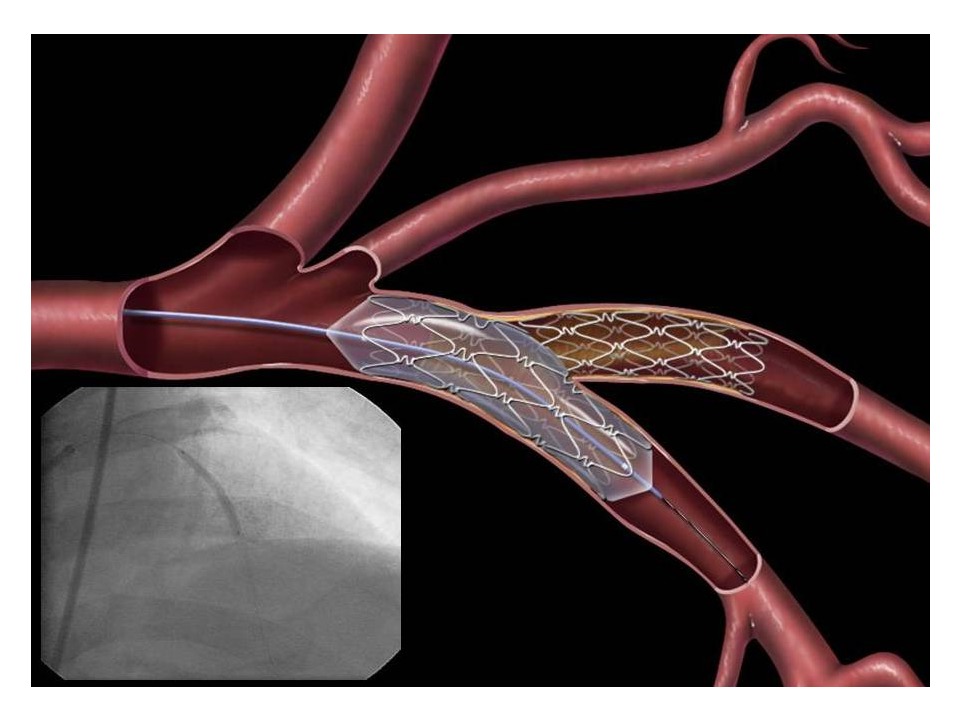 Balloon Alignment T-Stenting for Bifurcation Coronary Artery Disease ...