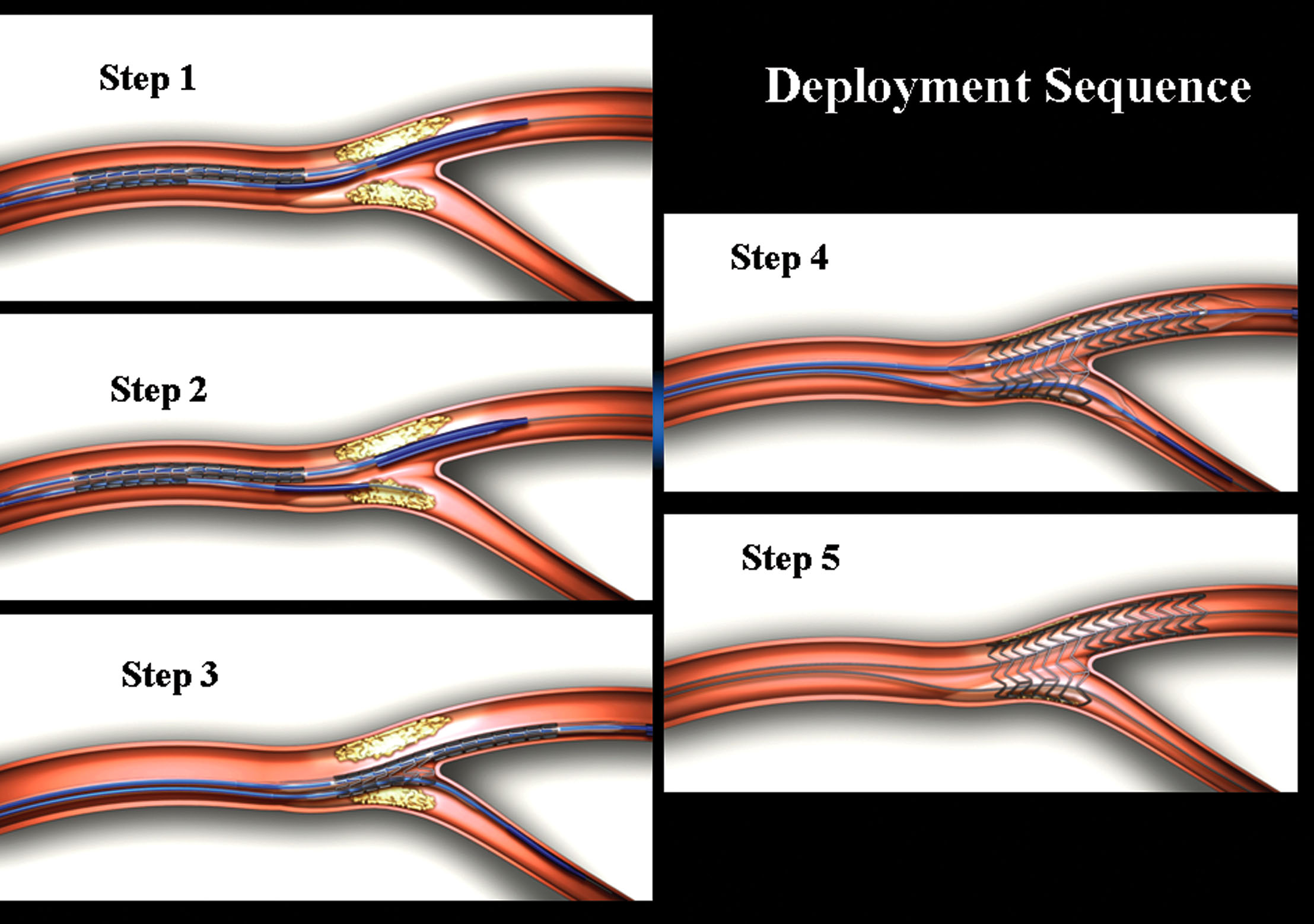 Bifurcation Coronary Artery Disease: Current Techniques and Future ...