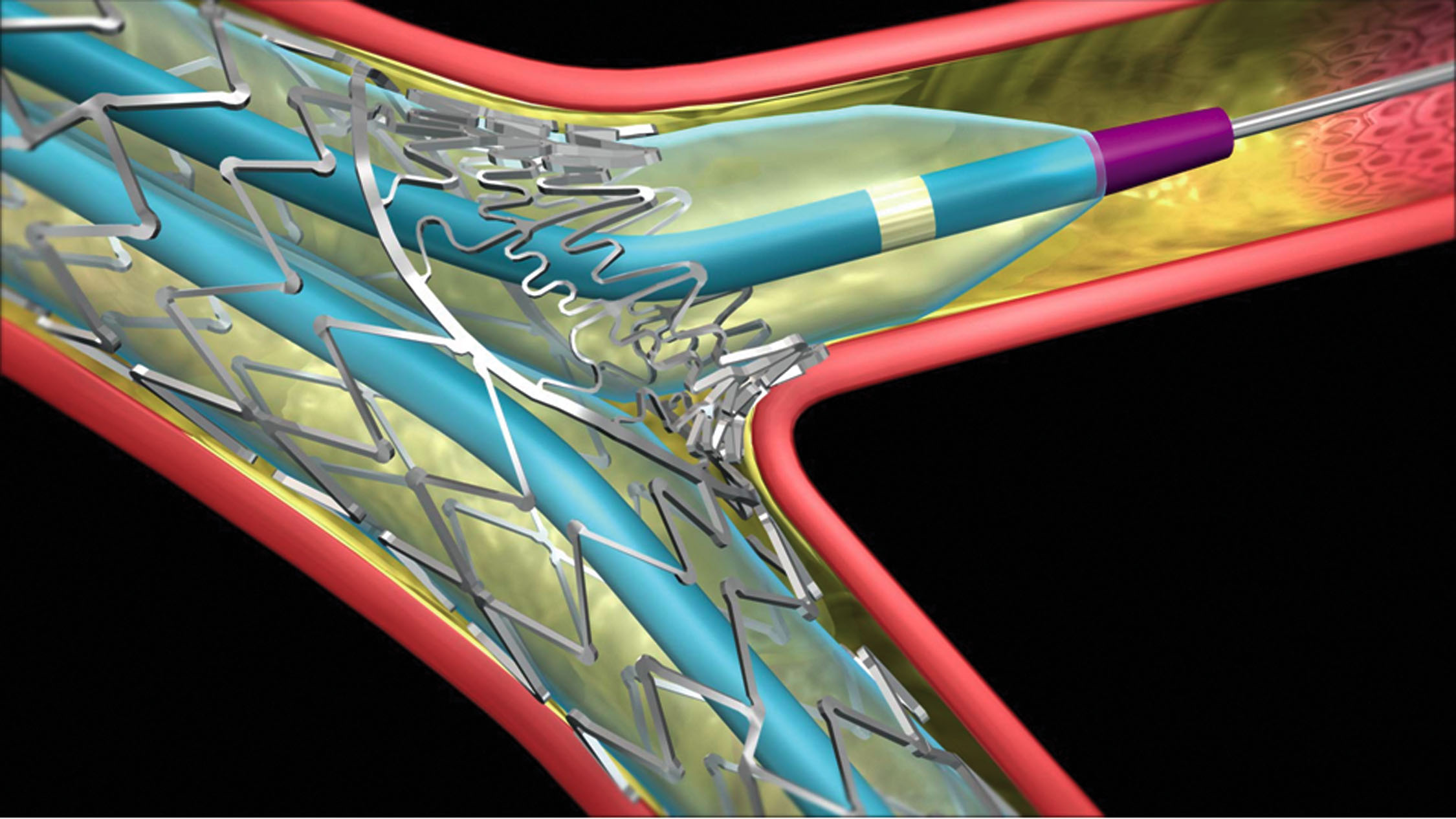 Bifurcation Coronary Artery Disease: Current Techniques and Future ...