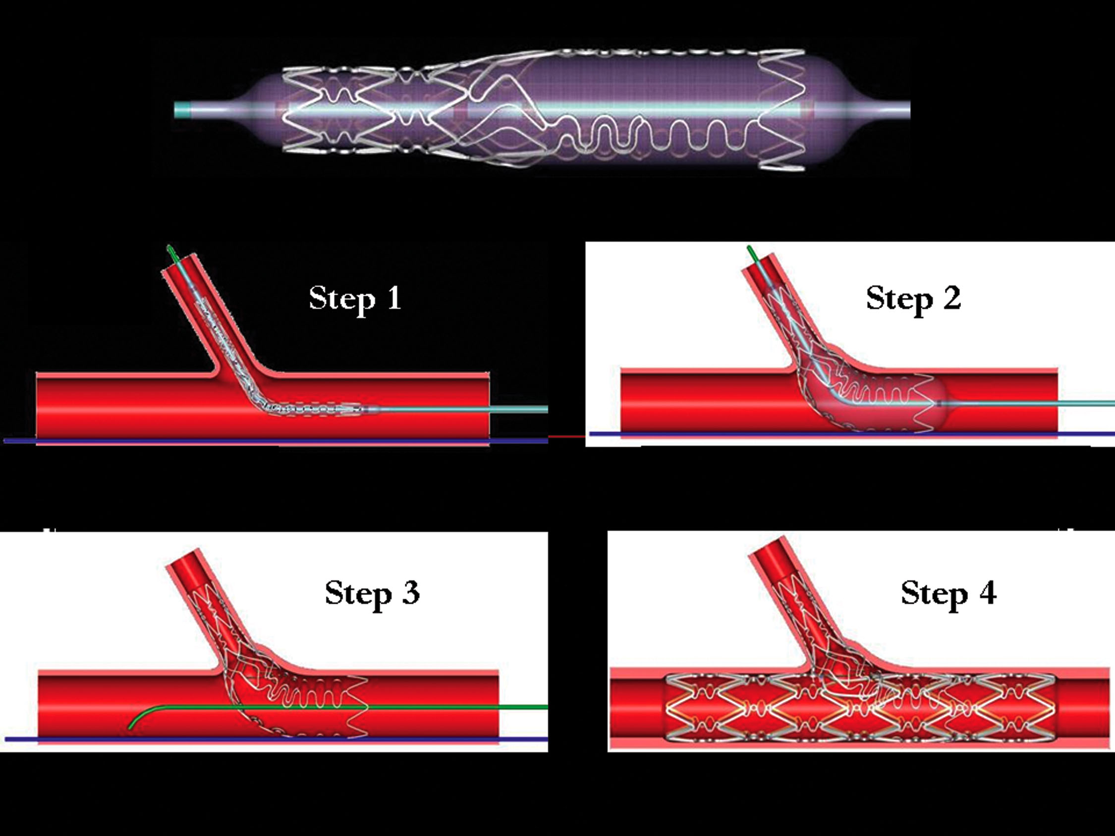 Bifurcation Coronary Artery Disease: Current Techniques and Future ...