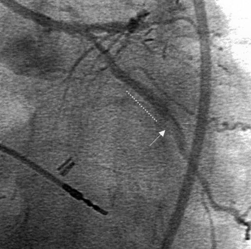 Coronary Artery Dissection and Perforation Complicating Percutaneous ...