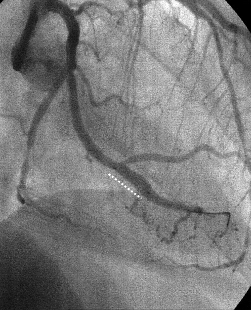 Coronary Artery Dissection and Perforation Complicating Percutaneous ...